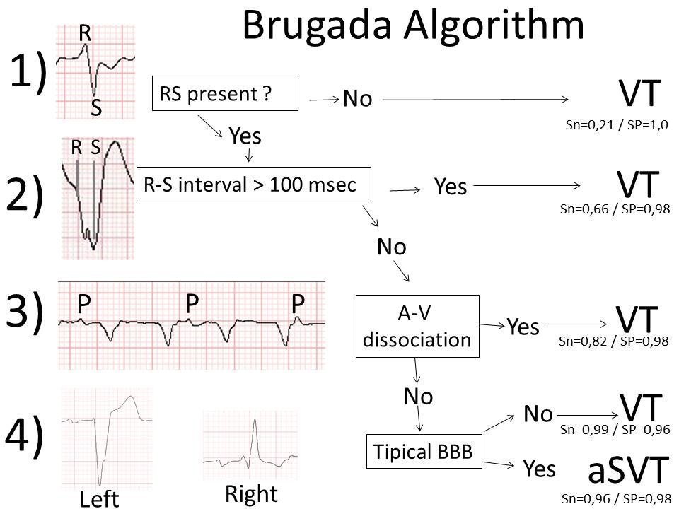 Tachicardia a QRS largo in paziente con cardiopatia infartuale - AIAC